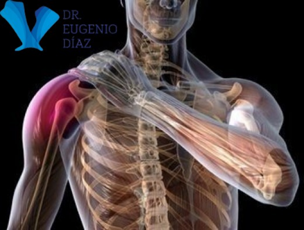 Tendinitis o bursitis - Lesiones del hombro | Dr Eugenio Díaz